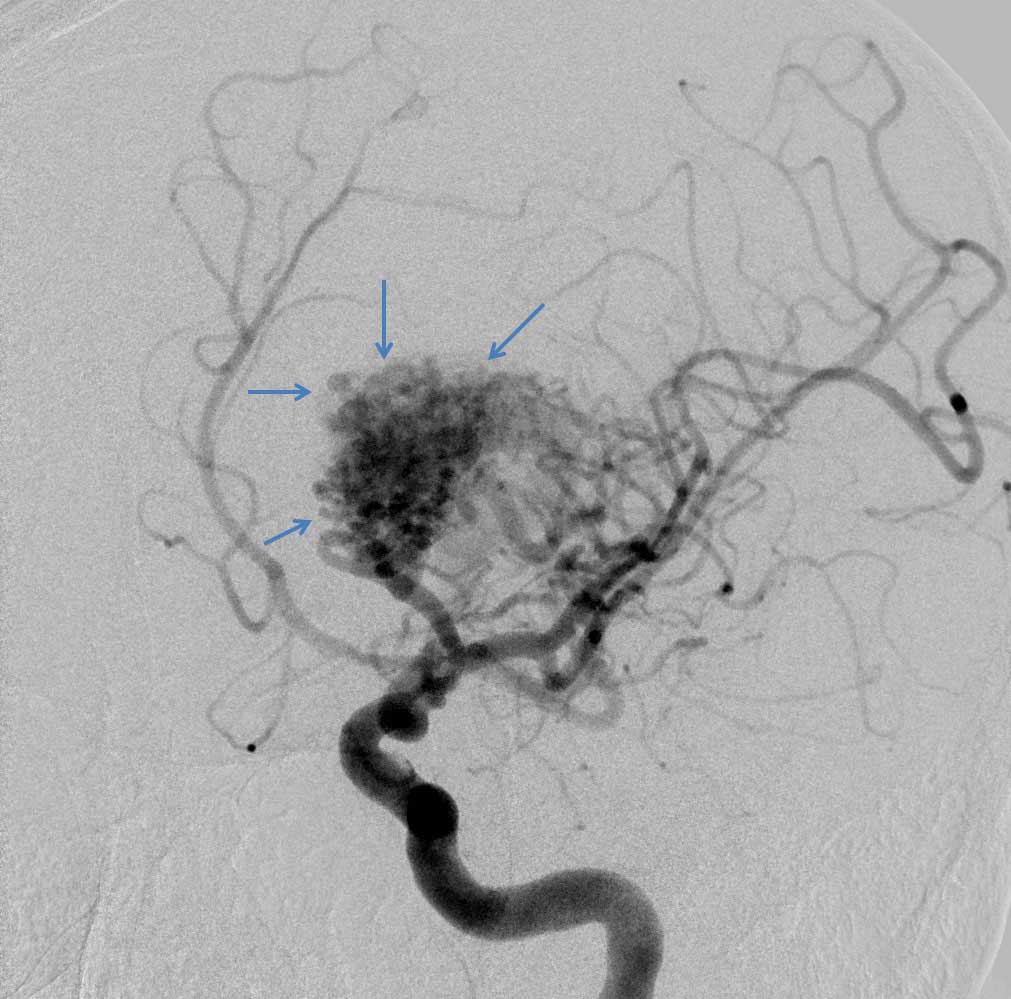 介入神经放射学- AVMs |斯坦福医疗保健